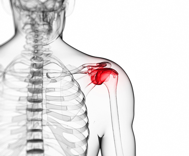 Zamrznjena rama (Adhezivni kapsulitis): Zdravljenje | GSC Blog